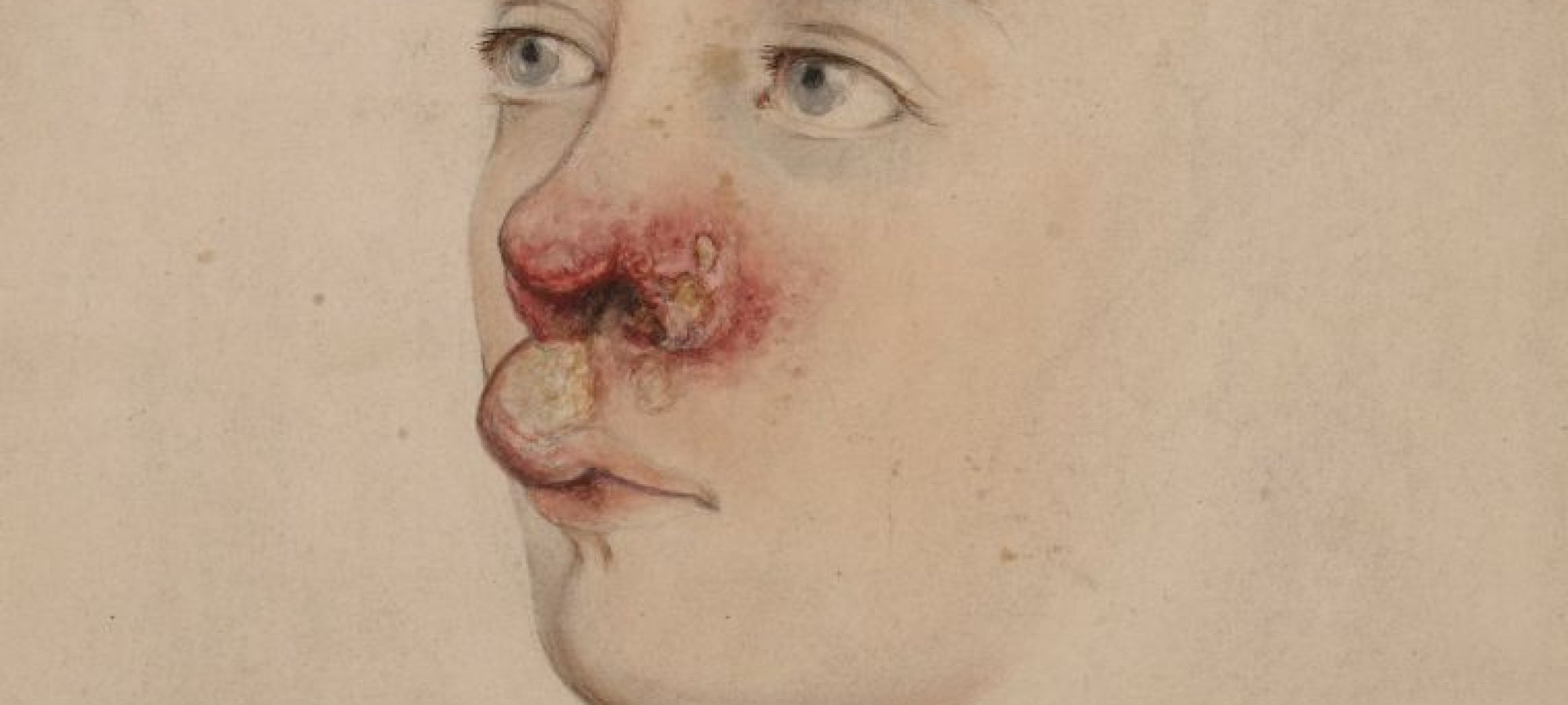 syphilis std on face